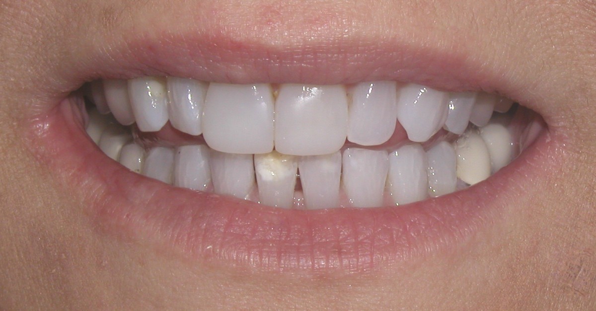 Transform Your Smile with Dental Implants Gallery