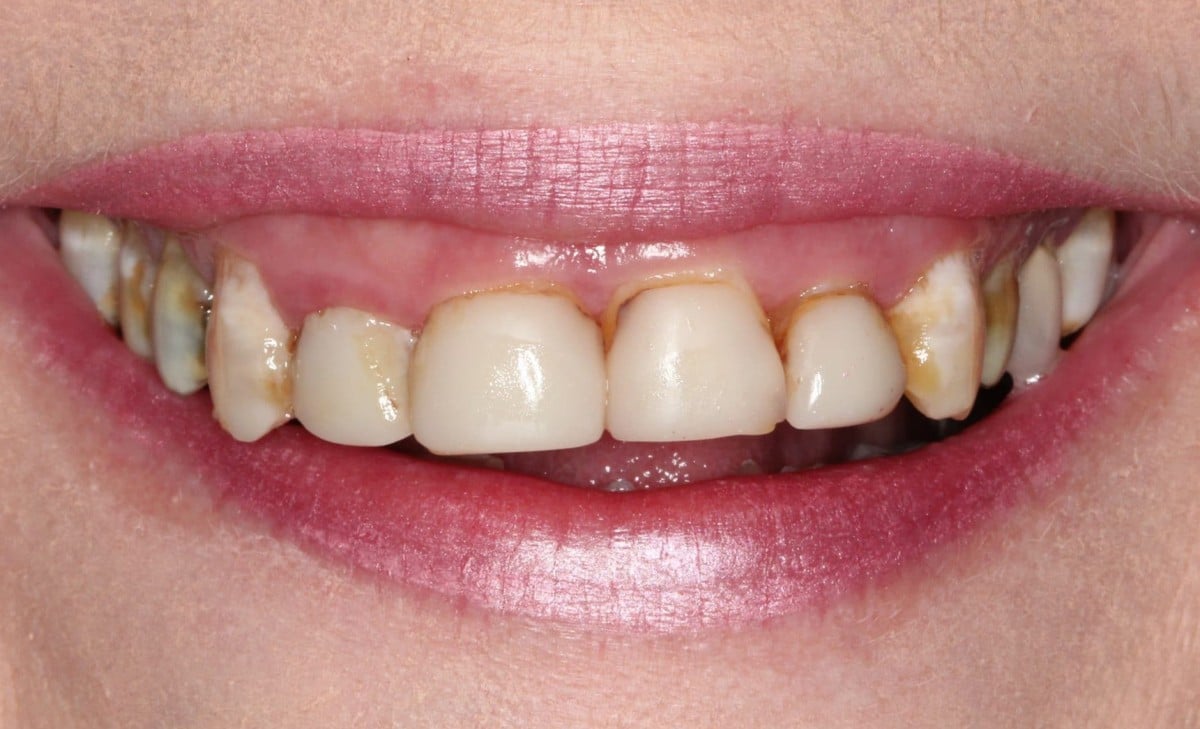 Before and After: Laser Gum Treatment in Wichita Falls