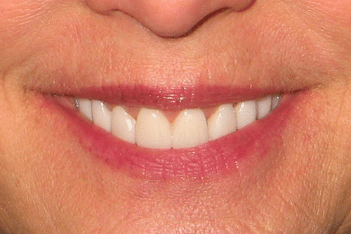 Before and After: Laser Gum Treatment in Wichita Falls