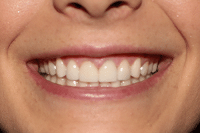 Before and After: Laser Gum Treatment in Wichita Falls