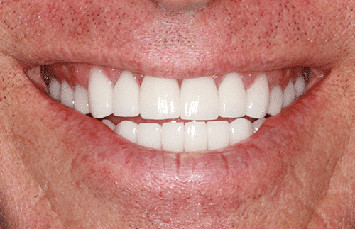 Gallery of TMJ Treatment: Before and After Results